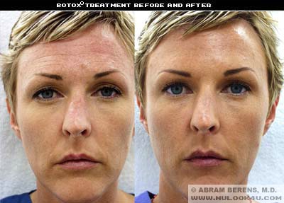 Ft Lauderdale BOTOX ® - in Fort Lauderdale South Florida